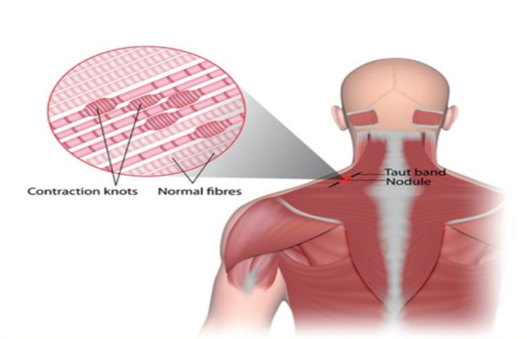 Understanding Myofascial Trigger Points in Human Body - Esra Rehab